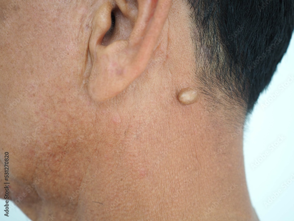 Foto de Stock Sebaceous cysts on his neck, formed by sebaceous glands ...