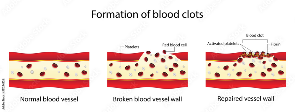 illustration of Biology and medical, Formation of blood clots, Blood ...
