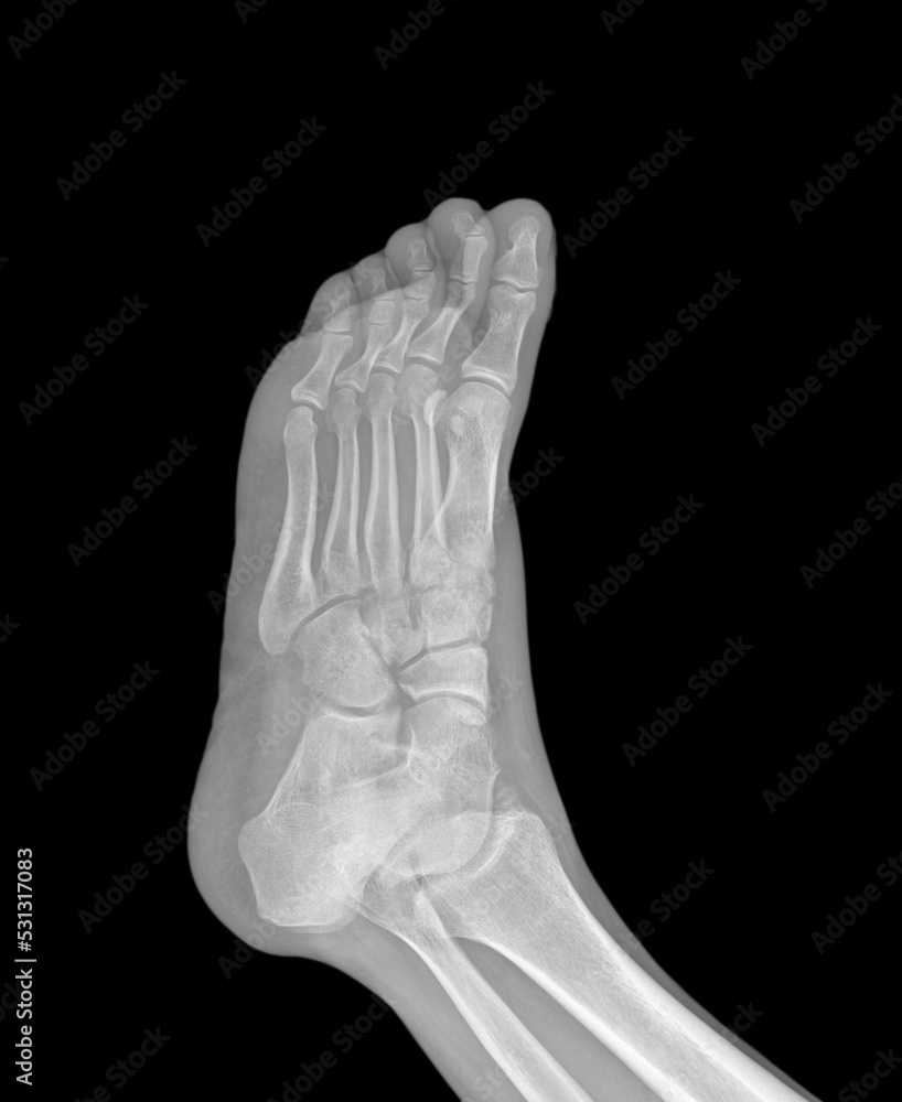 X ray of skeleton of foot. Human foot bones. Anatomy of joints. Foot ...