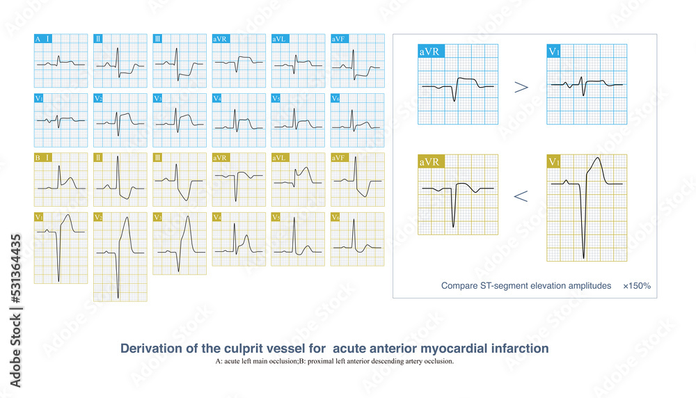 In acute extensive anterior myocardial infarction, the culprit vessel ...