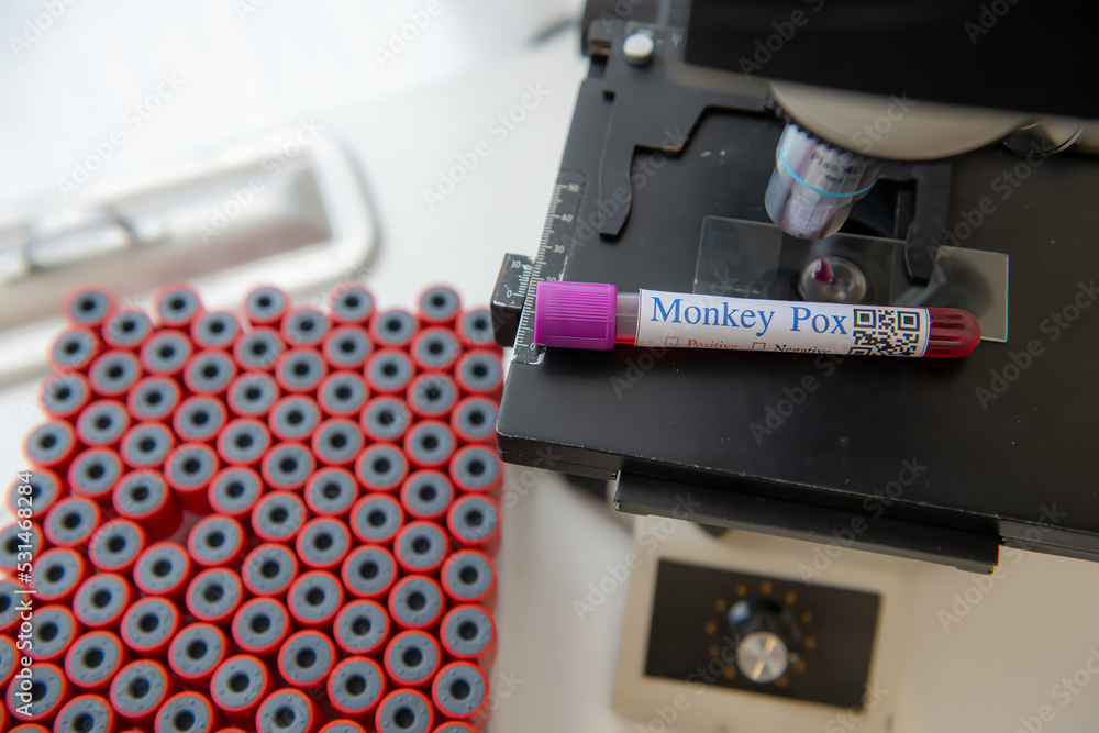 Stock-Foto „Blood sample tube for Monkeypox virus test. It is also ...