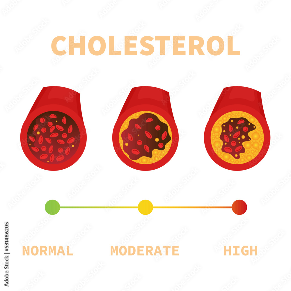 Cholesterol plaque in blocked blood vessel medical diagram. ldl and hdl ...