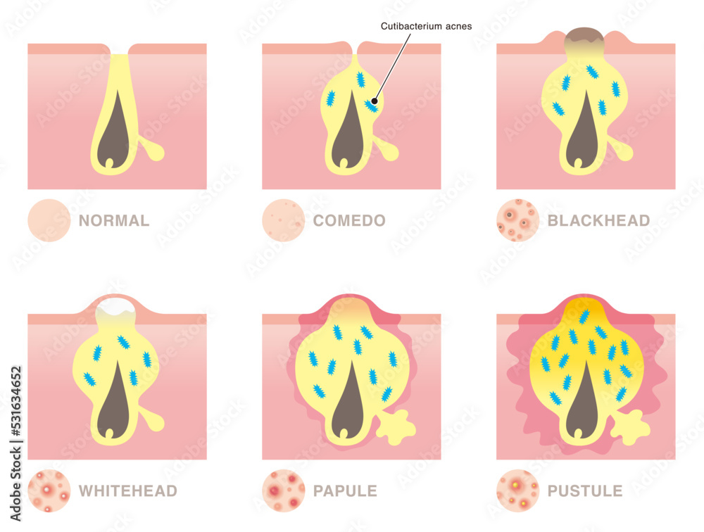 Types of acne. Comedo, blackhead, whitehead, papule, pustule. Vector ...