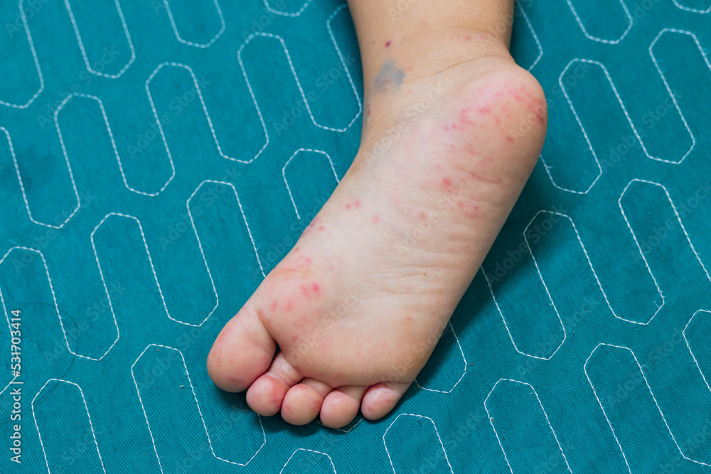 Photo Stock Enterovirus Leg arm mouth Rash on the body of a child ...