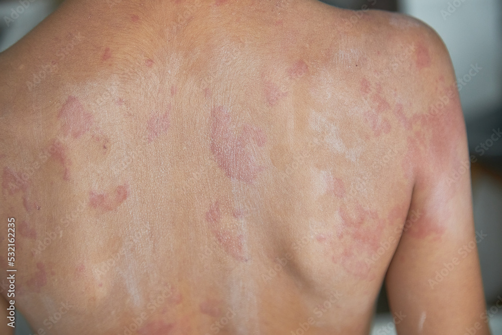 Itchy skin, dermatitis, food allergies. baby showing her back with acne ...