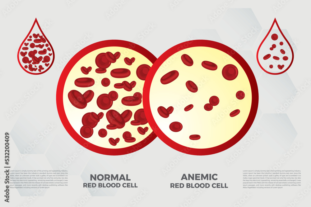Vector de Stock Anemia Iron red blood cell medical vector illustration ...