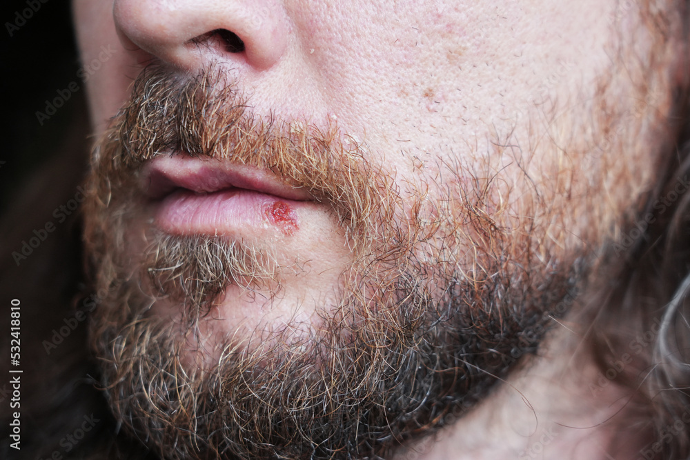 Foto de Stock Seborrheic dermatitis and cold sores. Man with long beard ...