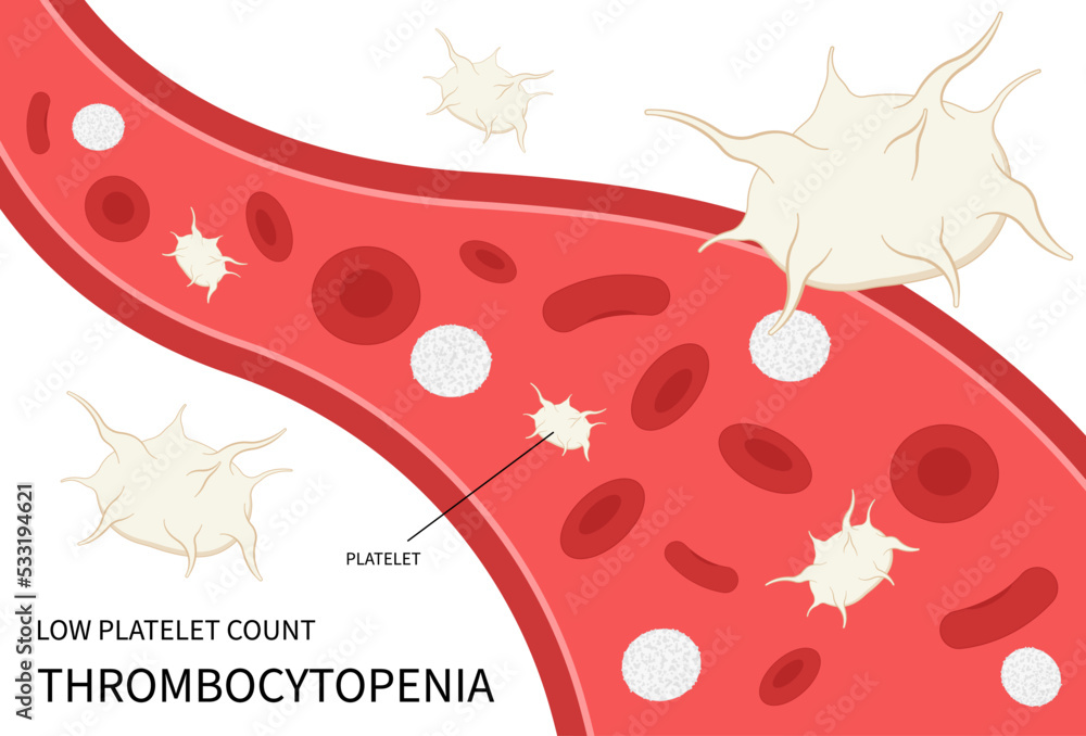 nosebleed disorder and hepatitis C with decreased complete low platelet ...