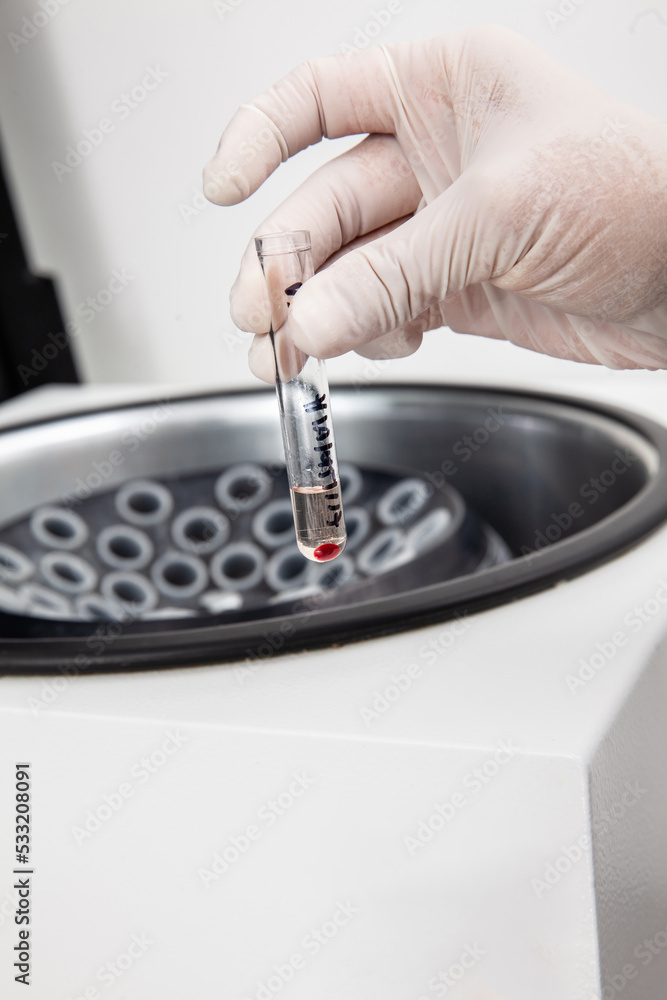 Test tube with bone marrow cells pellet obtained after centrifugation ... Test tube with bone marrow cells pellet obtained after centrifugation ...
