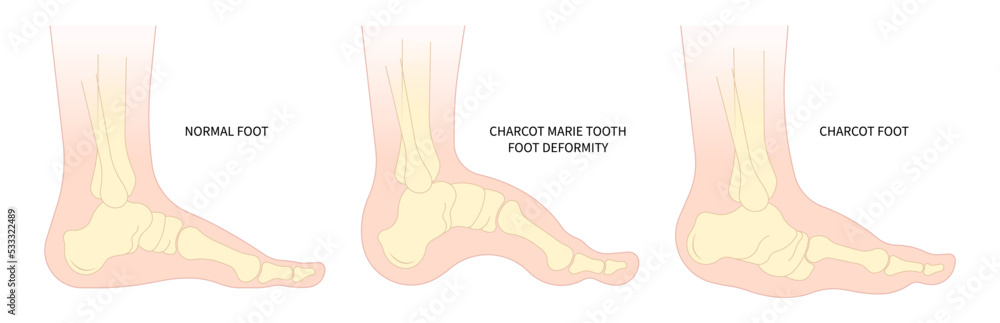 The Charcot foot anatomy painful and diabetic gout disease sores leg ...