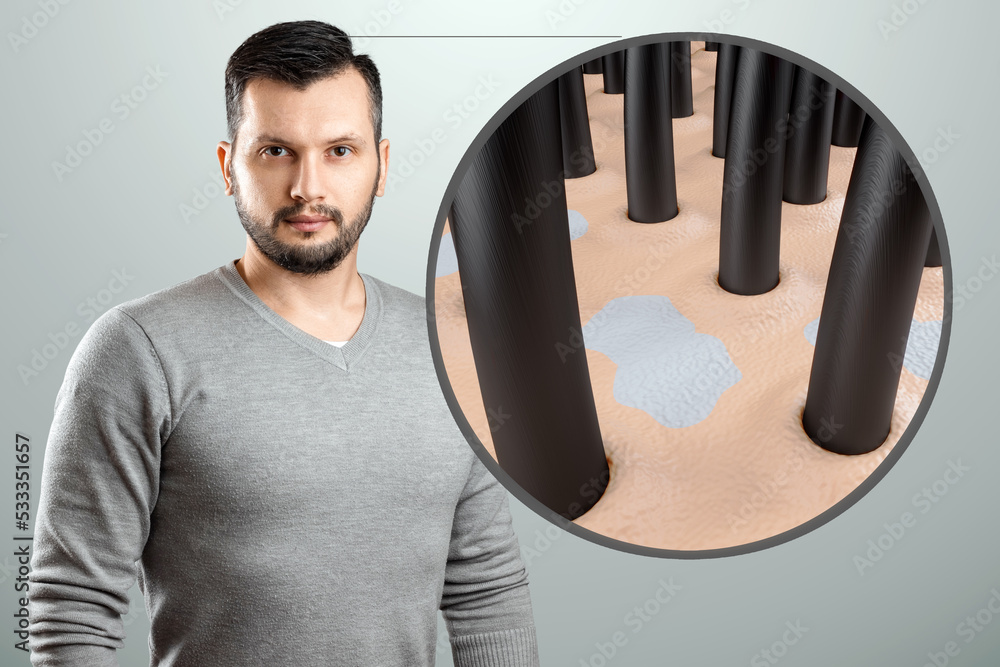 Fungal disease of the skin, dandruff on the scalp. An enlarged image of ...