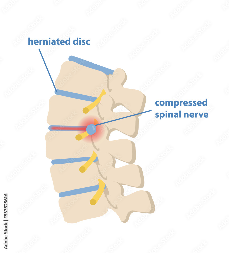 Sciatic nerve pinching concept. Pain in lumbar spine between vertebrae ...