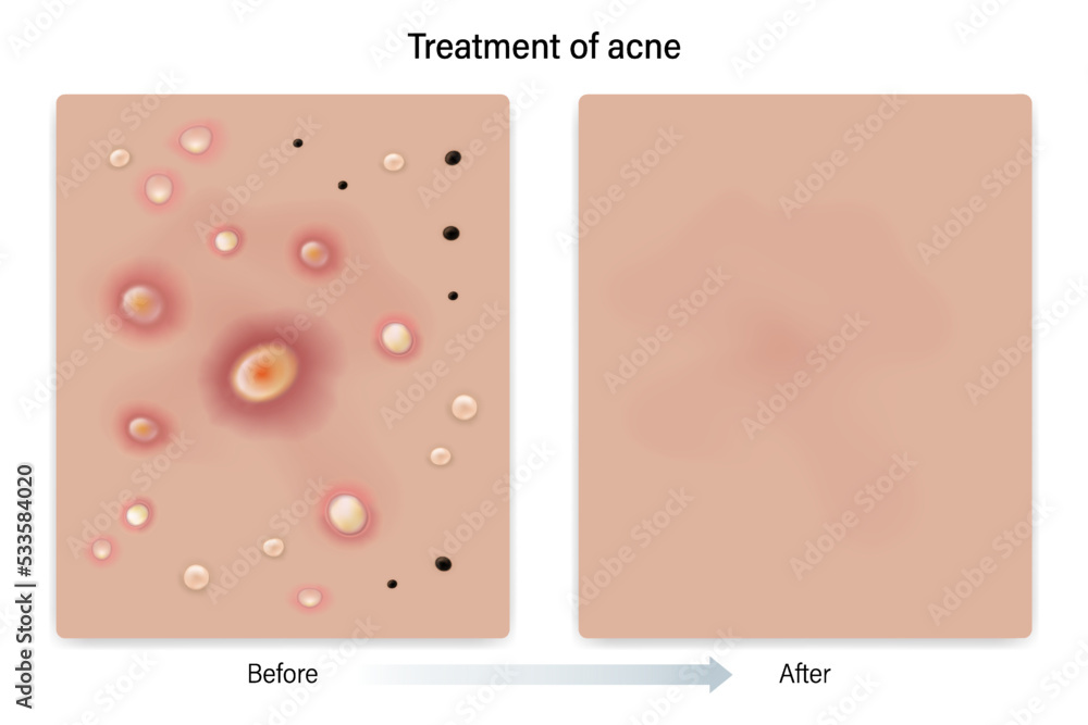 Treatment of acne. Skin before and after treatment. Blackheads ...