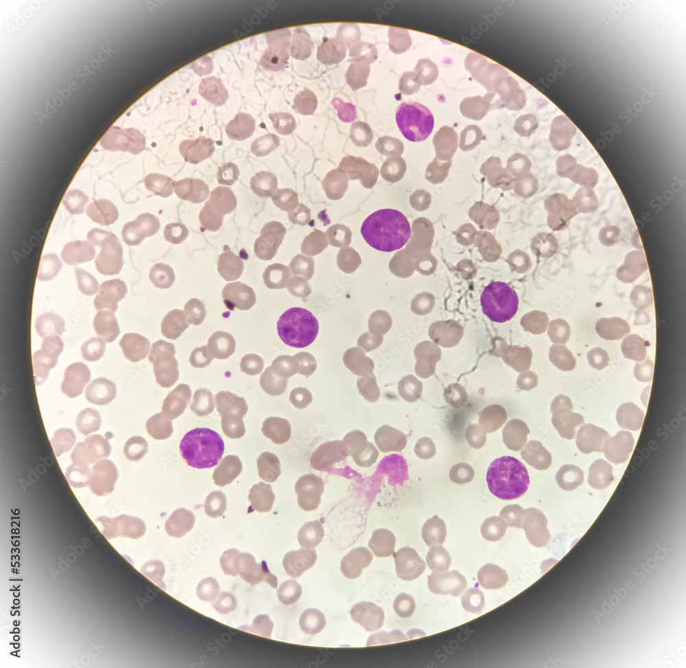 Microscopic image showing Chronic myeloid leukaemia (CML) is a type of ...