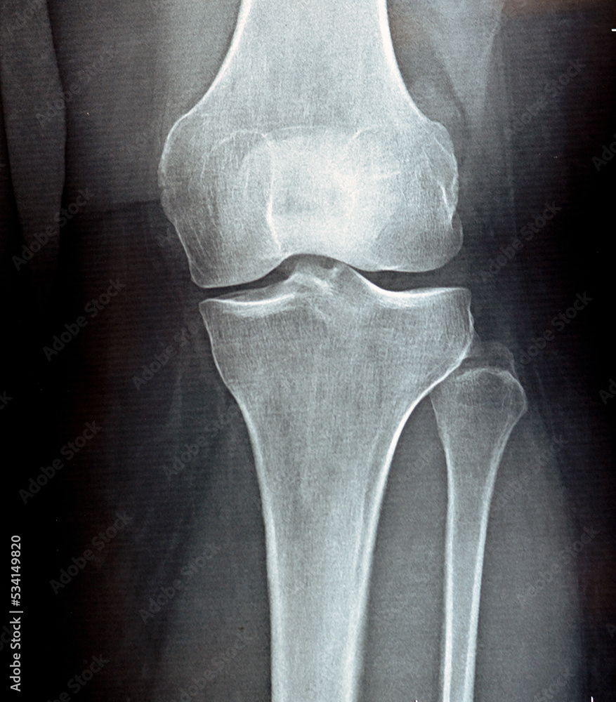 plain x ray on knee joint showing joint space narrowing and Subchondral Sclerosis on medial ...