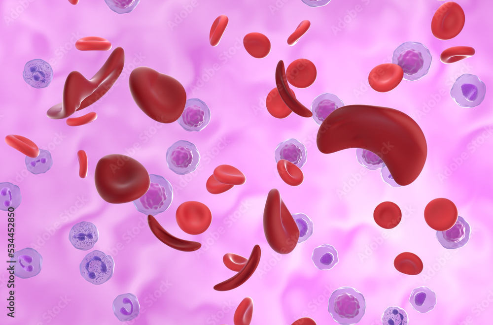Sickle cell Anaemia (Sickle cell disease SCD) cells in the blood flow ...