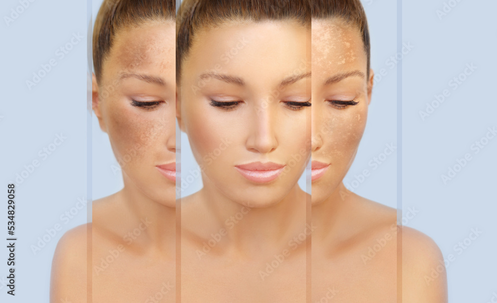 Dark spots, freckles,hyperpigmentation(melasma or chloasma),concept - skin lightening, skin ...