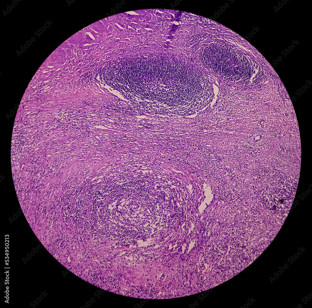 Photomicrograph of lymph node with Hodgkin's Disease (lymphoma ...