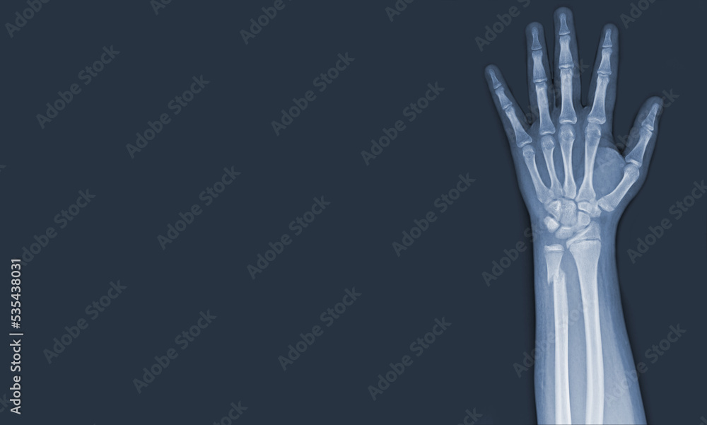 x-ray images of the hand and wrist joint to see injuries tendons and ...