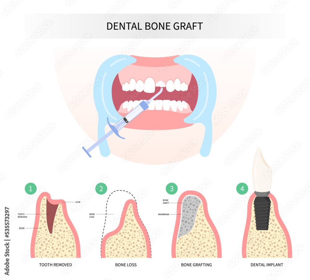 extraction Procedure of Teeth bone Graft surgery Stock Vector | Adobe Stock