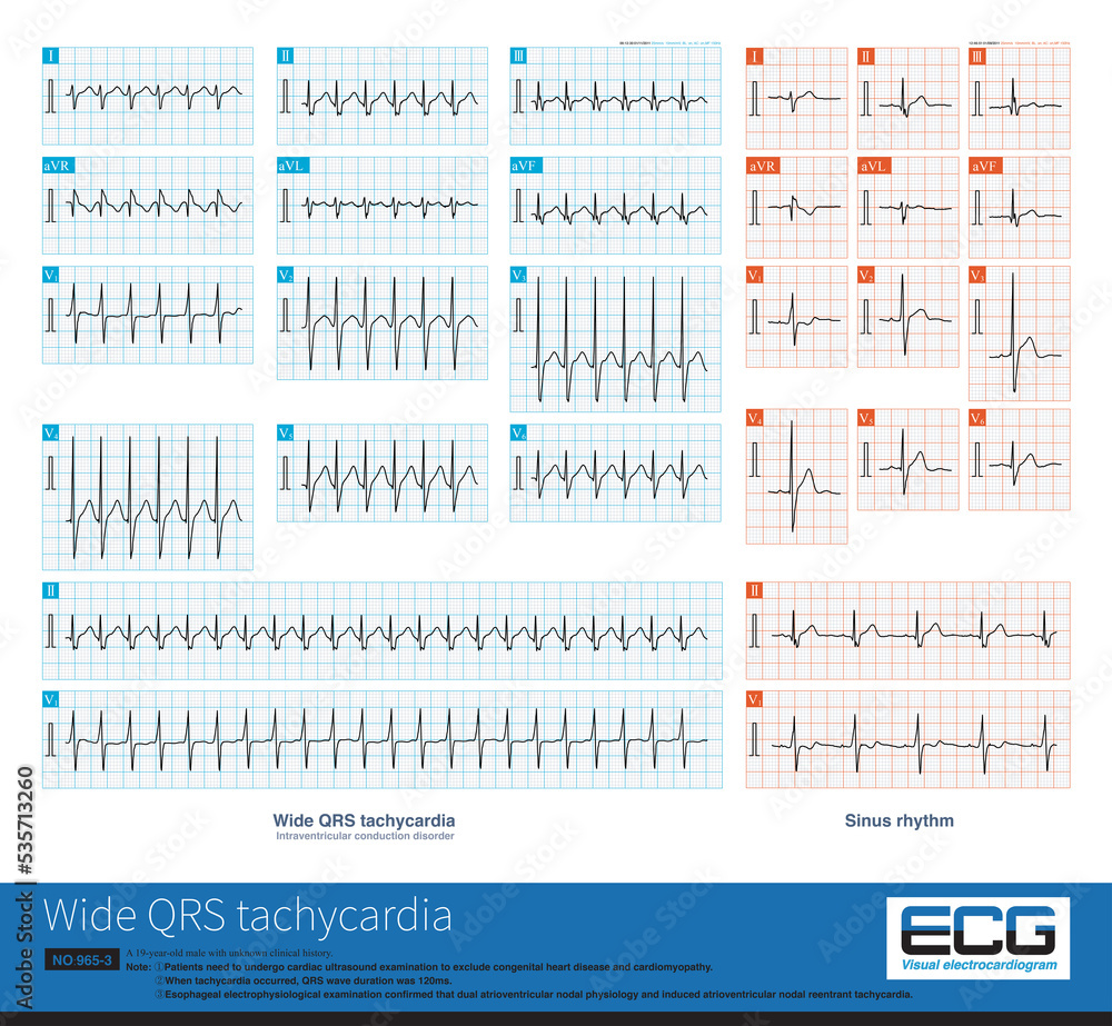 Stock-Illustration „If there is basic intraventricular conduction ...