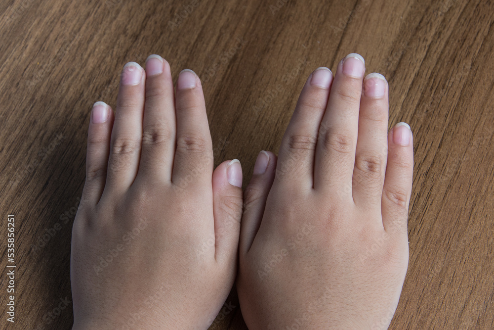 Stock-Foto „White Spots on Children's Nails, Due to Calcium Deficiency ...