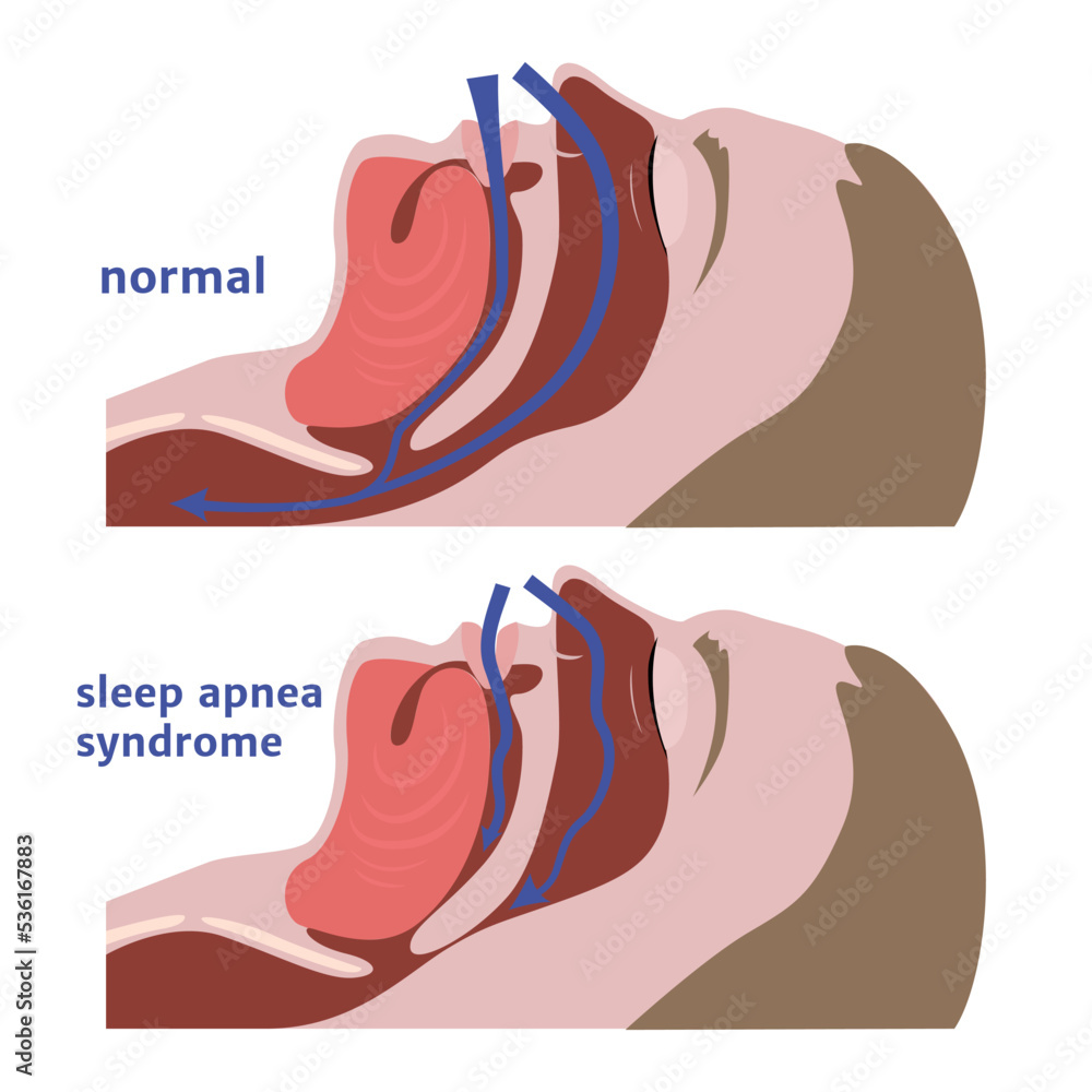 Sleep apnea. Respiratory tract diagram. Medical poster. Vector ...