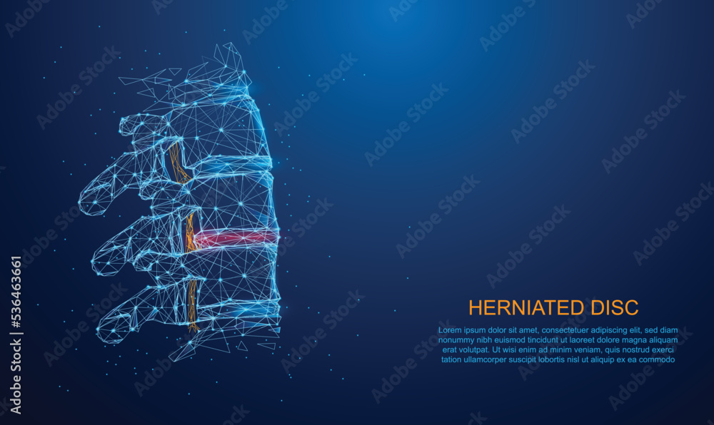 Herniated disk concept and spine pain diagnostic in low polygon ...