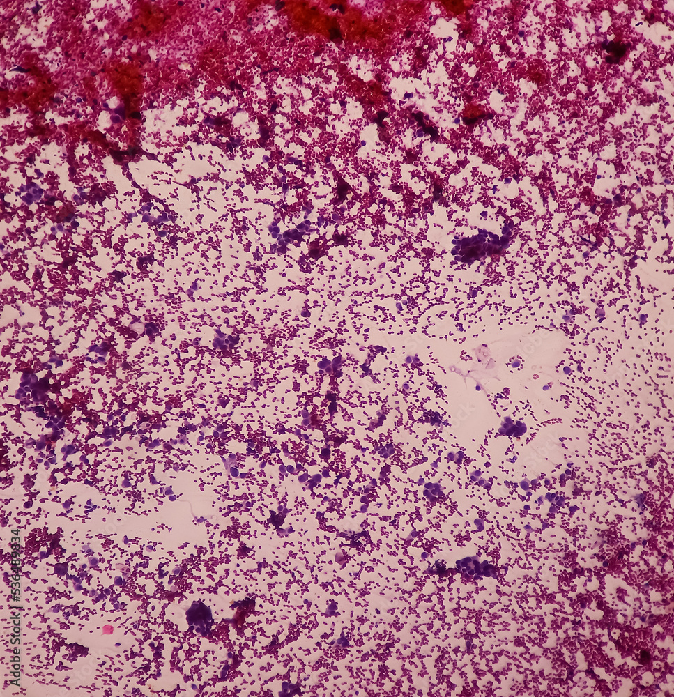 Axillary lymph node(FNA Cytology): Positive malignant cell, Metastatic ...