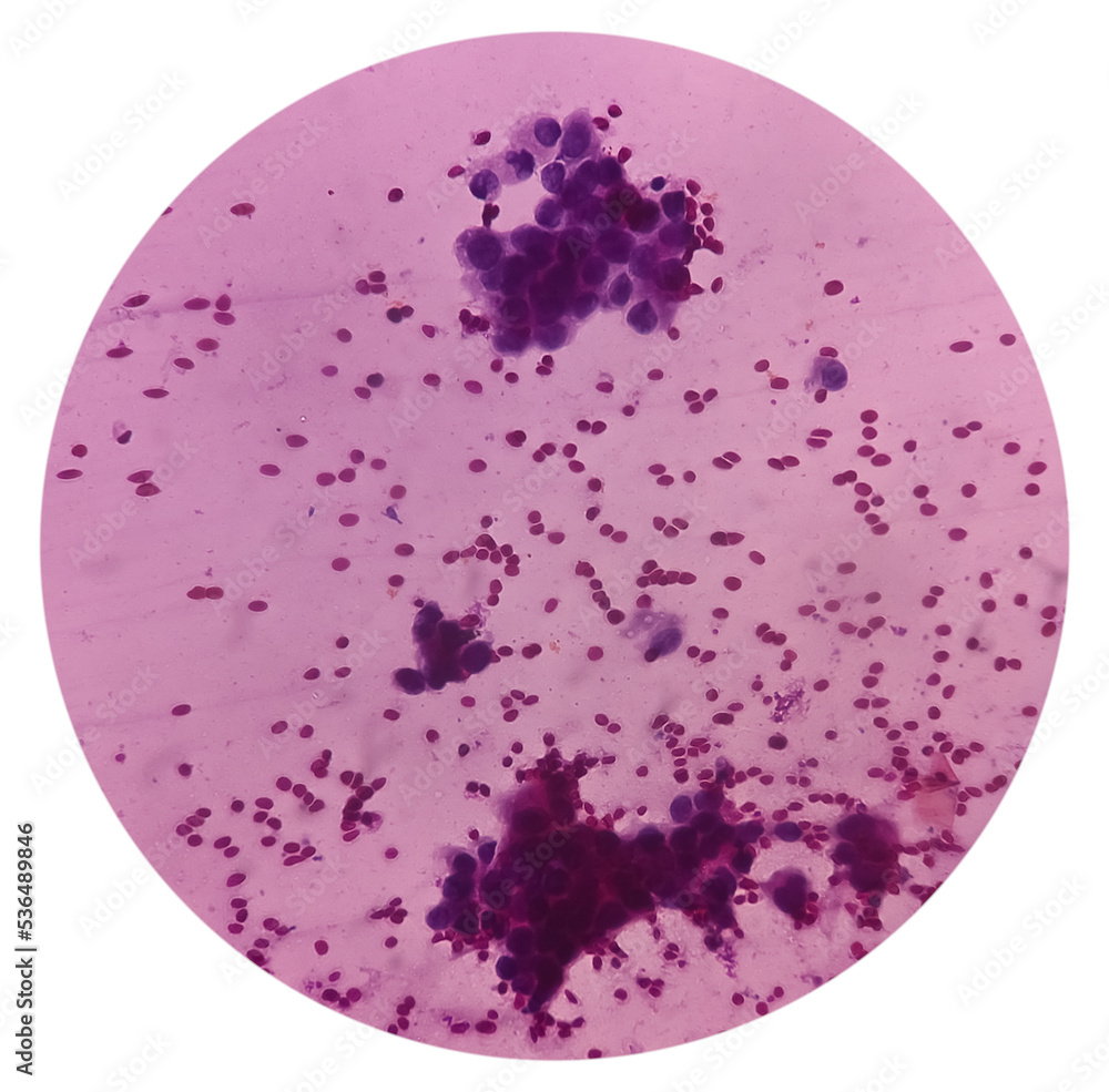 Axillary lymph node(FNA Cytology): Positive malignant cell, Metastatic ...