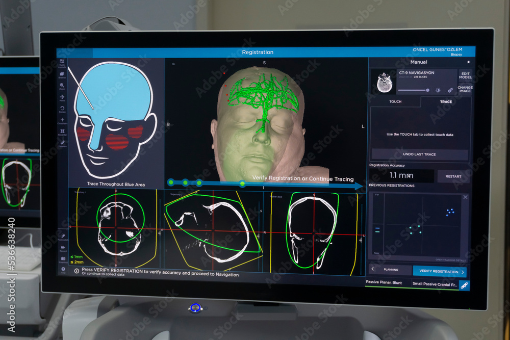Step by step Visualase is an MRI-guided laser ablation system used to ...