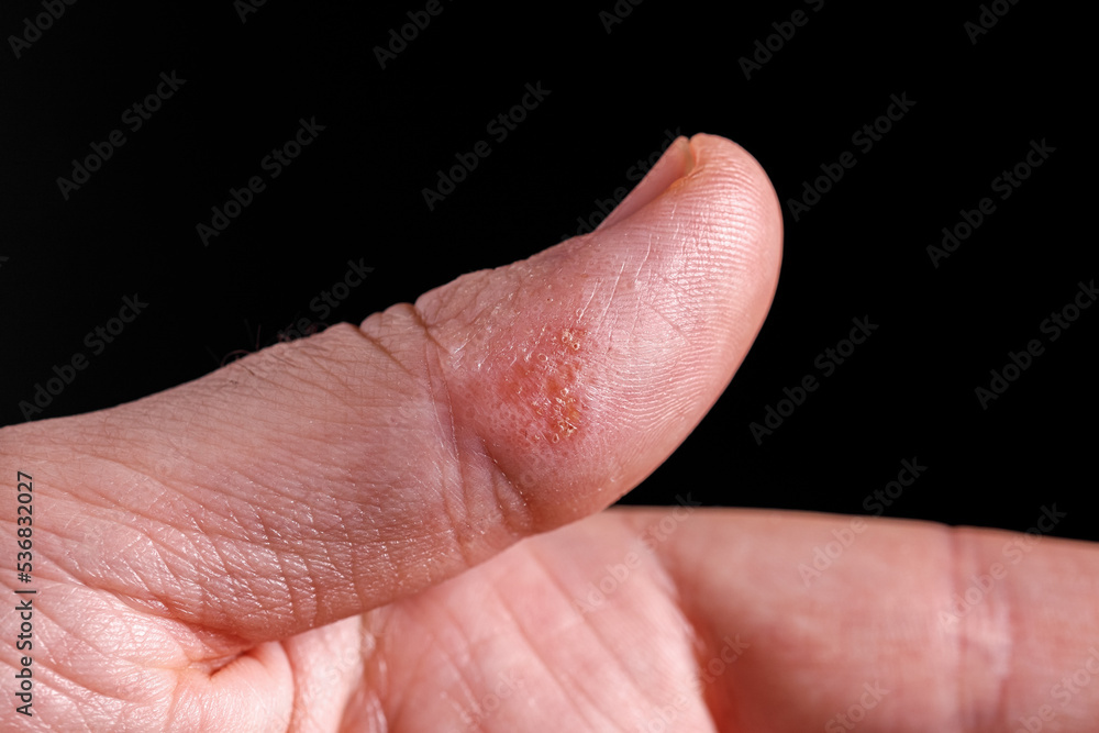 Herpes on finger, Shingles, Zoster or Herpes Zoster symptoms on arm ...