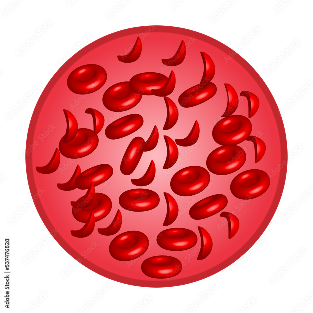 Anemia. Sickle cell anemia. sickle red blood cells. Sickle cell disease ...