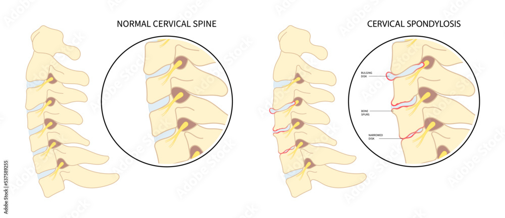 Spinal cord pinched nerves and painful Tingling Numbness hand of ...