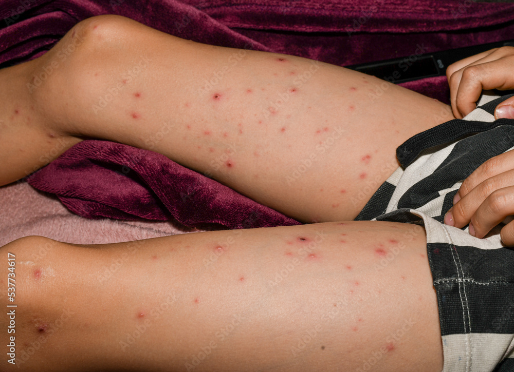 Photo Stock Chickenpox on the body of a child, Severe chicken pox ...