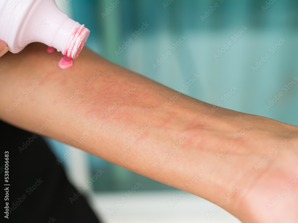 Photo Stock Urticaria on hand woman non-lethal type from food and air ...
