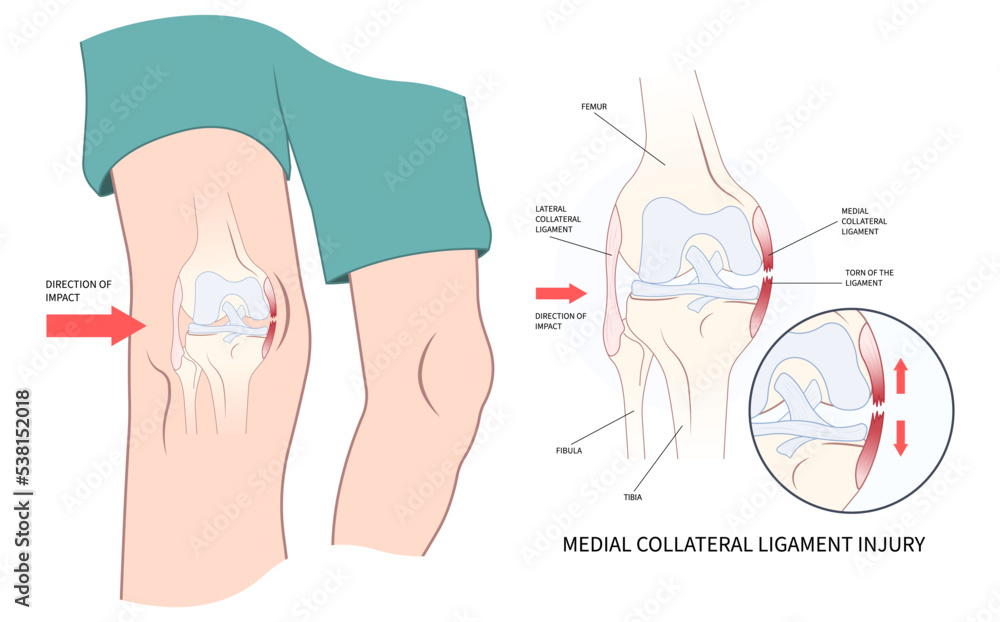 classification of Medial collateral ligament Injury test athletic ...