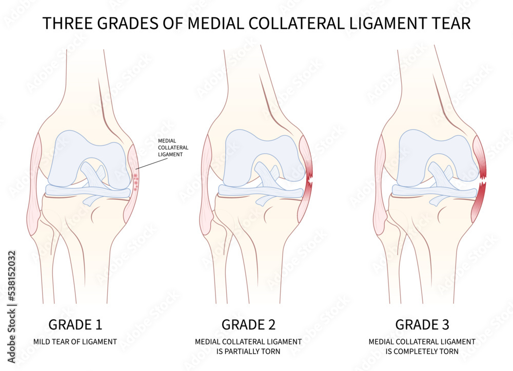 classification of Medial collateral ligament Injury test athletic ...