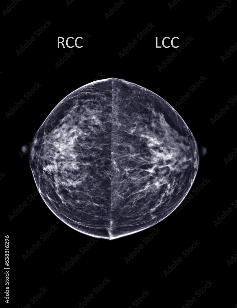X-ray Digital Mammogram or mammography of both side breast Standard ...