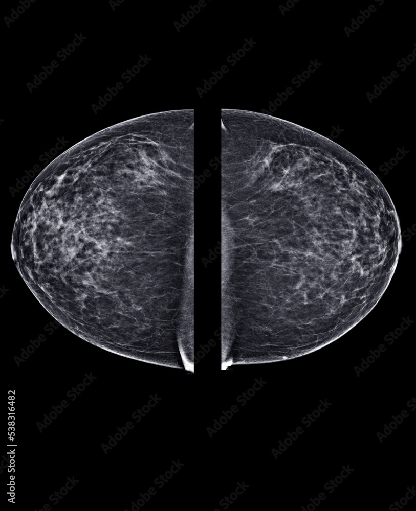 X Ray Digital Mammogram Or Mammography Of Both Side Breast Standard Views Are Bilateral