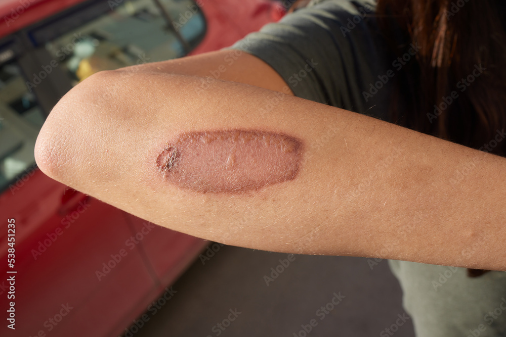 Cut wound on arm and a chemical burn from hydrogen peroxide. Close up ...