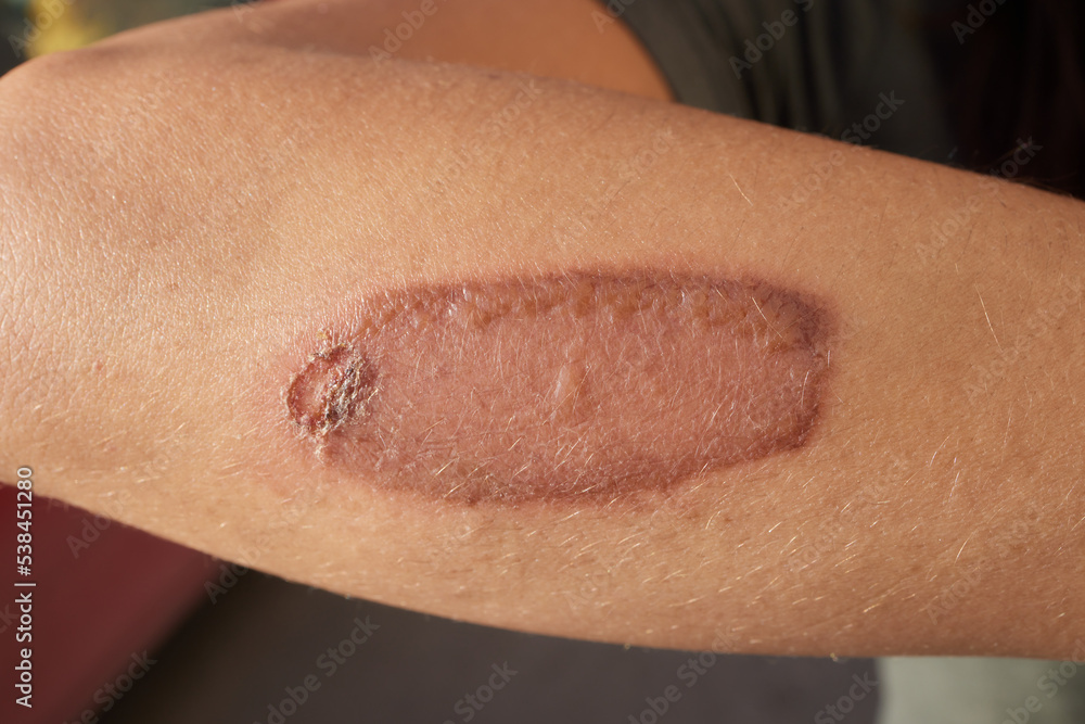 Cut wound on arm and a chemical burn from hydrogen peroxide. Close up ...