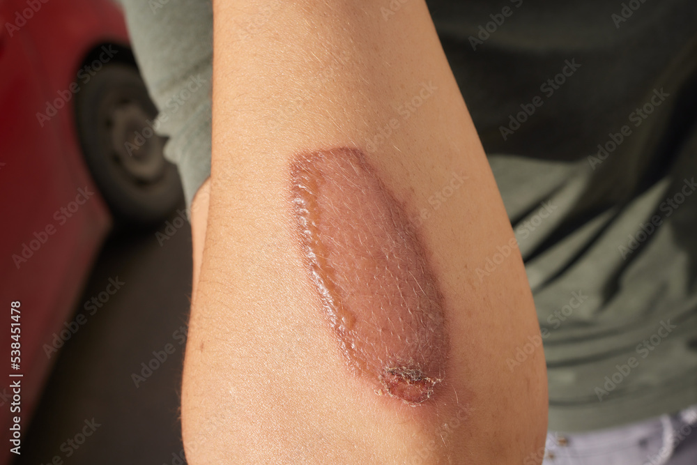 Cut wound on arm and a chemical burn from hydrogen peroxide. Close up ...