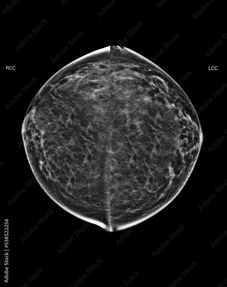 X-ray Digital Mammogram or mammography of both side breast Standard ...