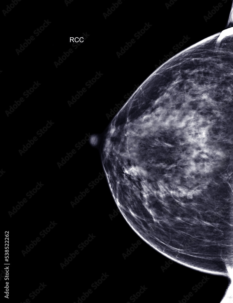 X-ray Digital Mammogram or mammography of both side breast Standard ...