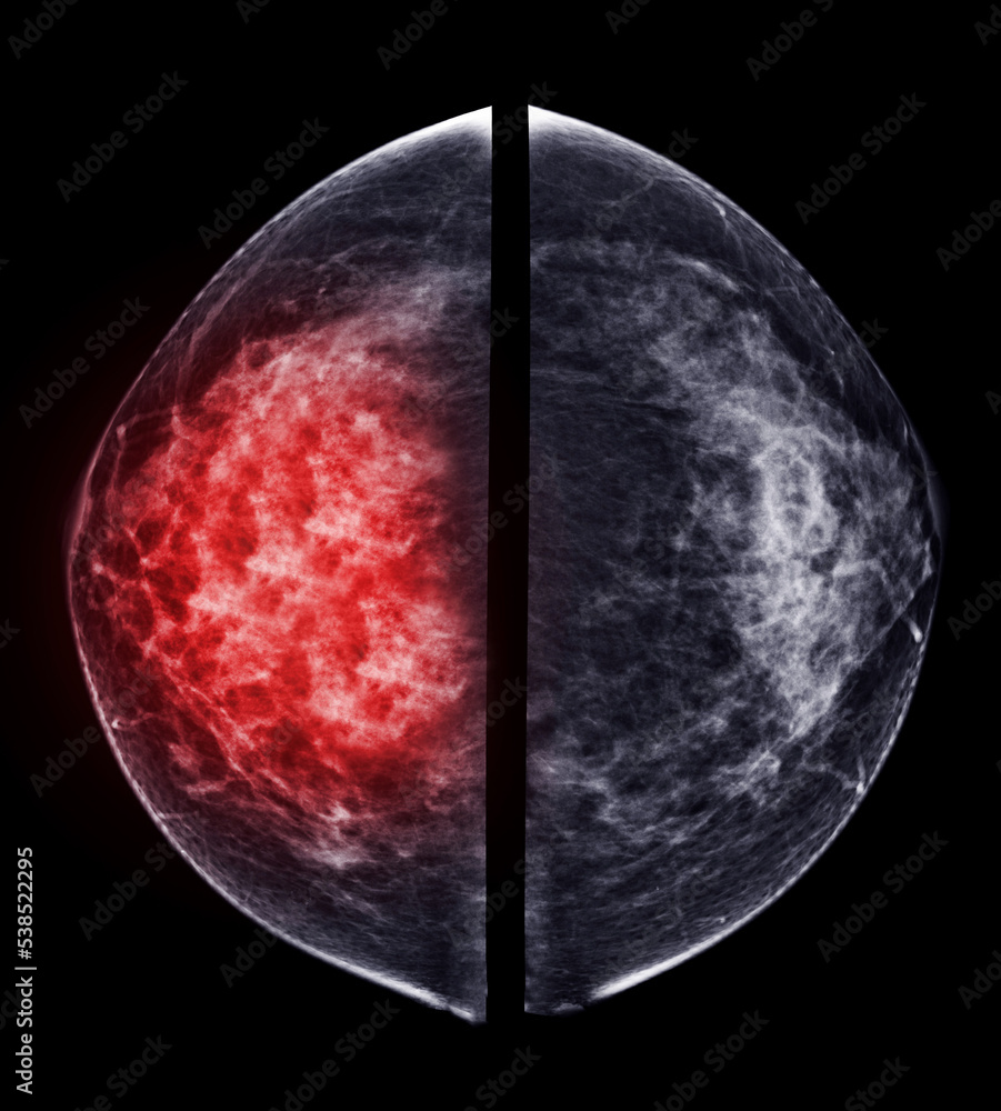 X-ray Digital Mammogram or mammography of both side breast Standard ...