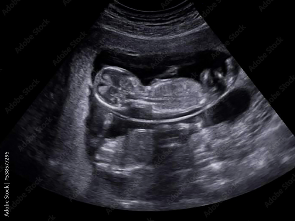 An ultrasound x-ray of a baby in the womb Stock Photo | Adobe Stock