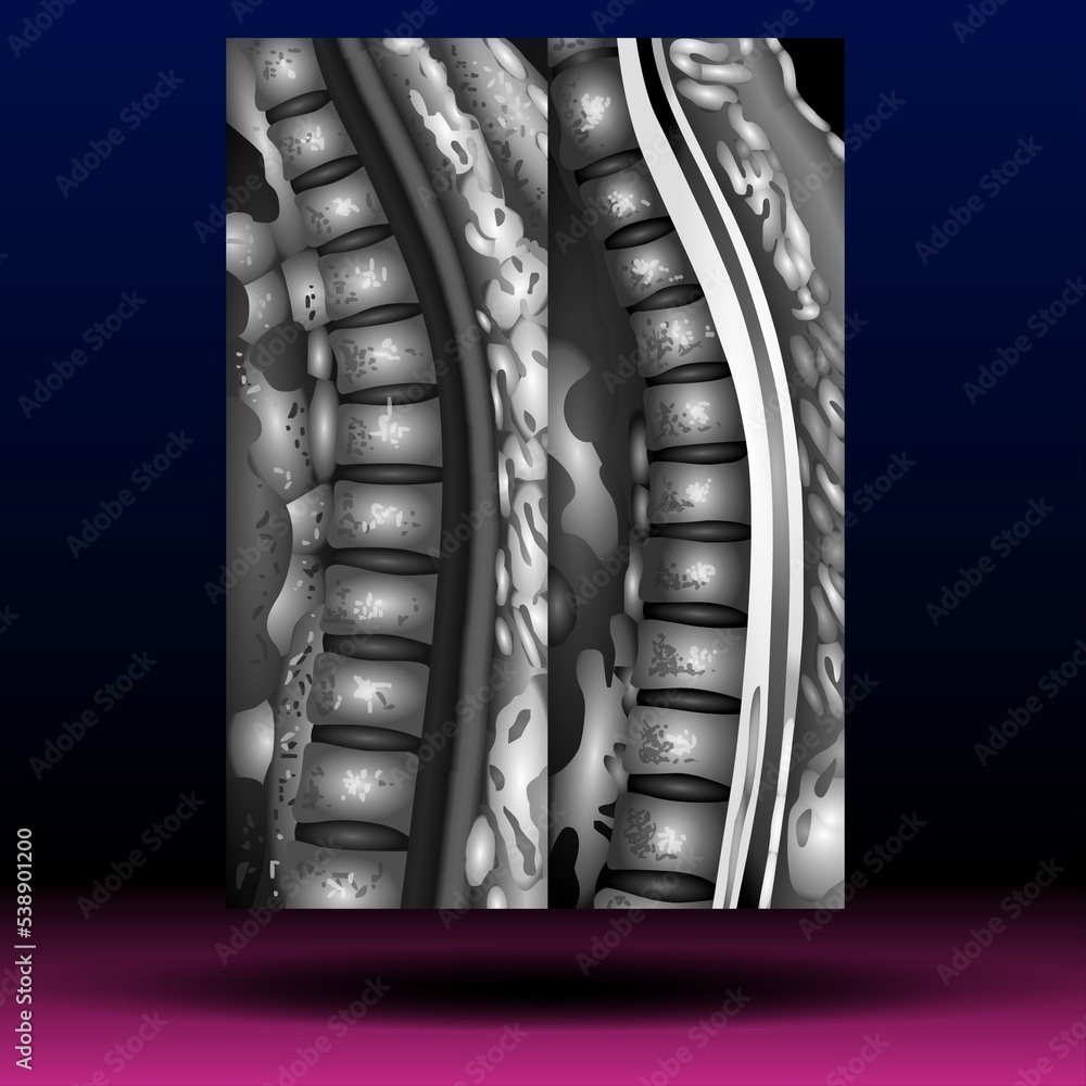 X-ray Myelography - Fla source file available - Magnetic resonance ...
