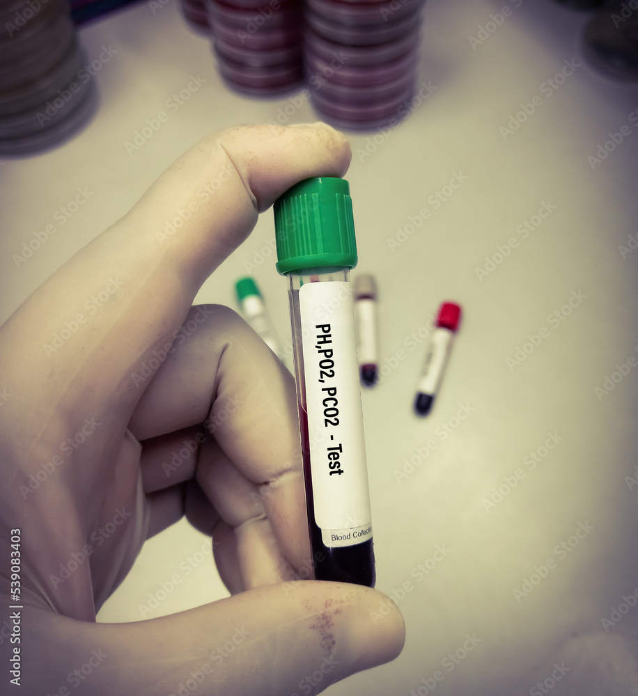 Blood sample for PH, PO2 (partial pressure of oxygen) and PCO2 (partial ...