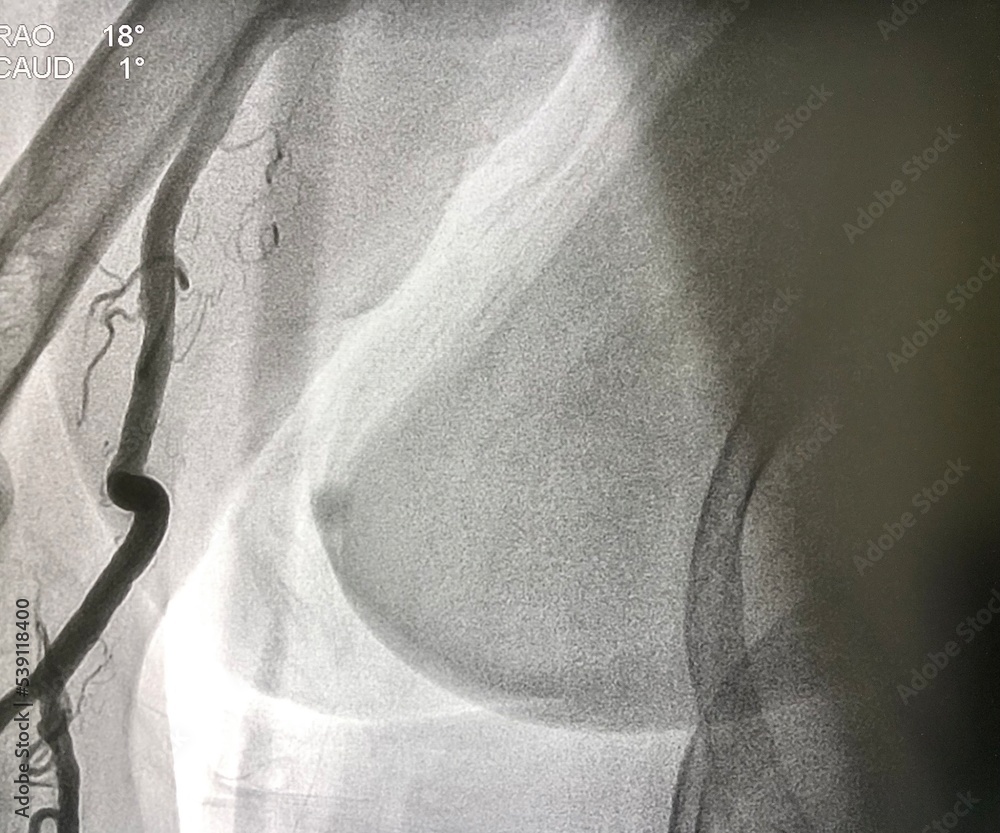 Angiogram shown tortuous right radial artery. Stock Photo | Adobe Stock